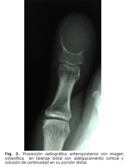 Quiste de inclusión epidérmica intraóseo con osteólisis de la falange ...