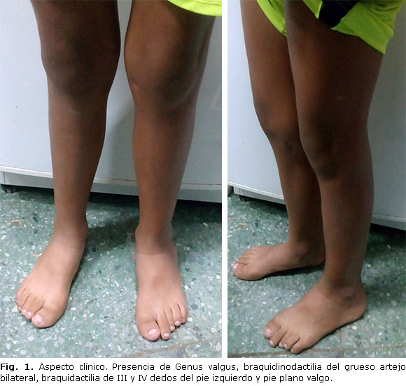 Rótula bicapa bilateral | Marrero Riverón | Revista Cubana de Ortopedia ...