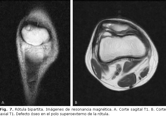 Rótula bicapa bilateral | Marrero Riverón | Revista Cubana de Ortopedia ...