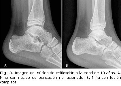 Patrones radiológicos normales del calcáneo en niños | Vergara Amador ...