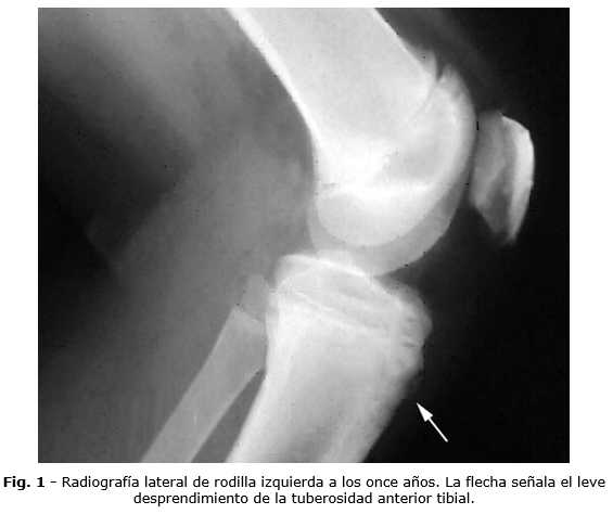 Enfermedad de Osgood-Schlatter | Martínez Miranda | Revista Cubana de ...