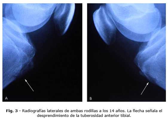 Enfermedad de Osgood-Schlatter | Martínez Miranda | Revista Cubana de ...