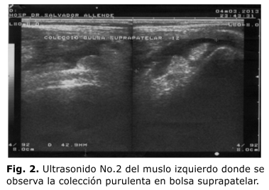 Piomiositis tropical vs Leptospirosis | García Ducongé | Revista Cubana ...