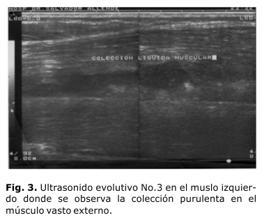 Piomiositis tropical vs Leptospirosis | García Ducongé | Revista Cubana ...