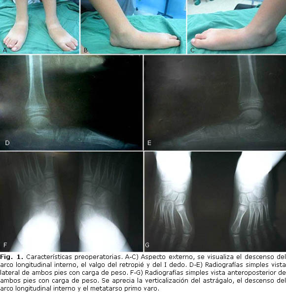 Técnica calcáneo-stop con elongación de tendones peroneos en el pie ...