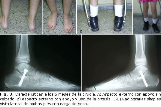 Técnica calcáneo-stop con elongación de tendones peroneos en el pie ...